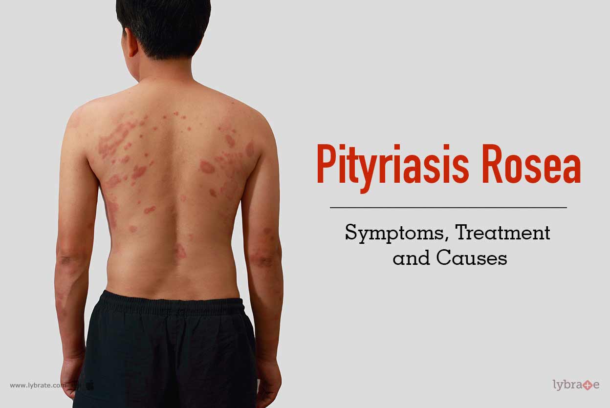 Pityriasis Rosea Pictures Causes Symptoms Treatment