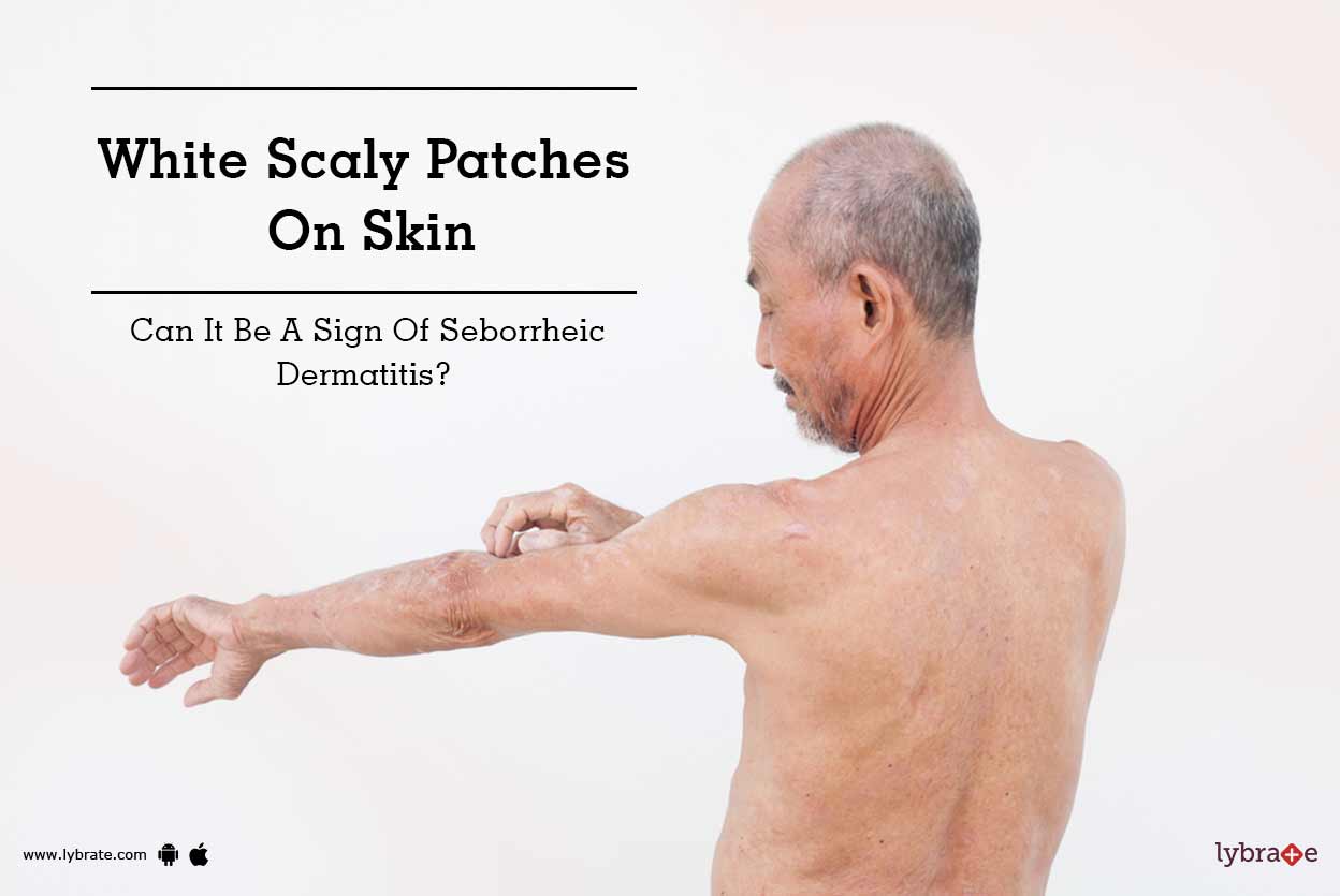 White Scaly Patches On Skin - Can It Be A Sign Of Seborrheic Dermatitis ...